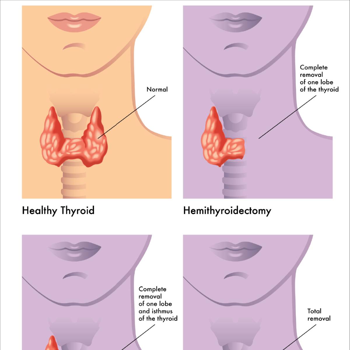 Hemithyroidectomy
